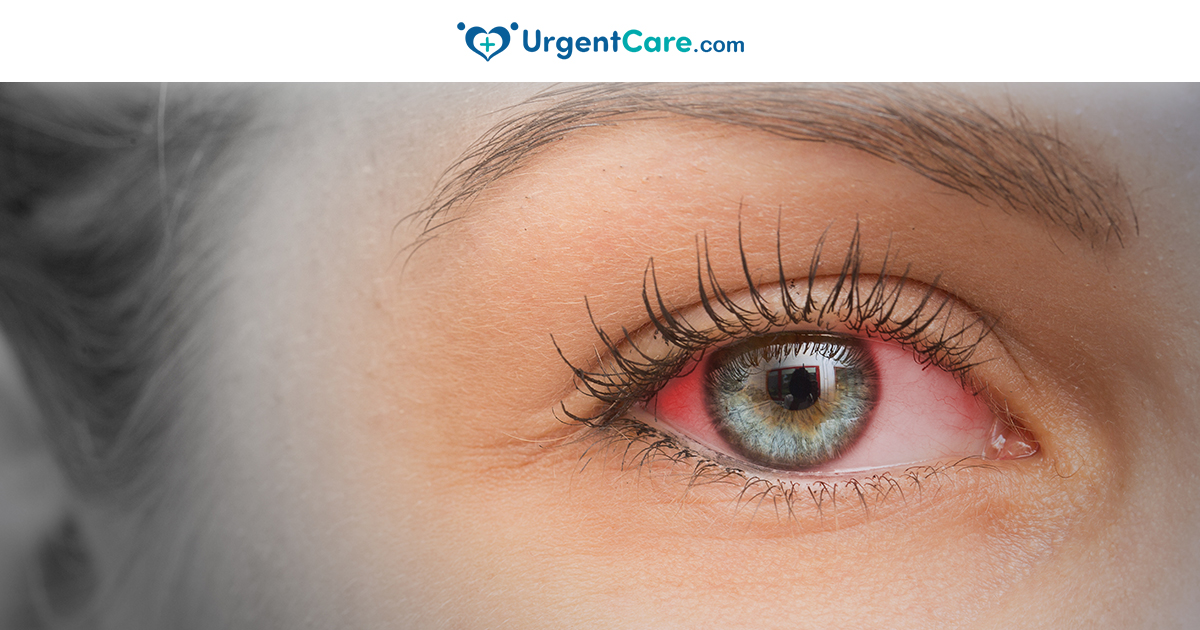 Pink Eye is Covered by Telemedicine